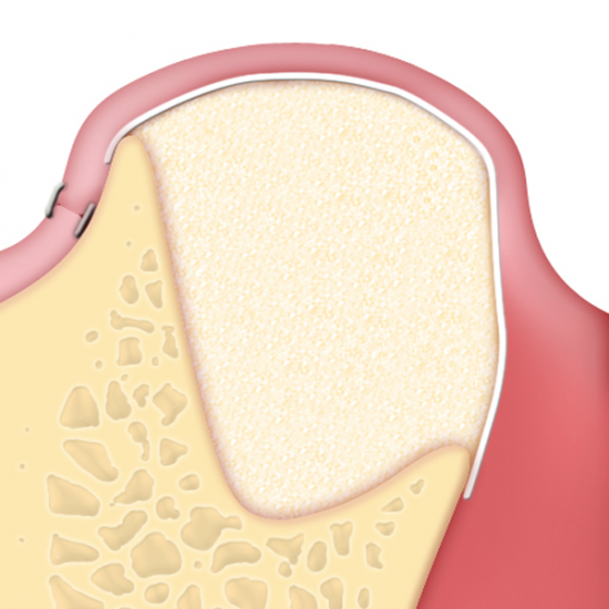 EVOLUTION - OSTEO BIOL - TECNOSS - SP Dental