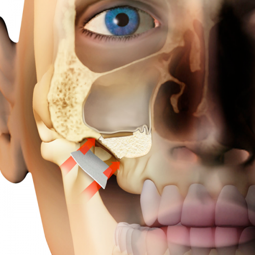 EVOLUTION - OSTEO BIOL - TECNOSS - SP Dental